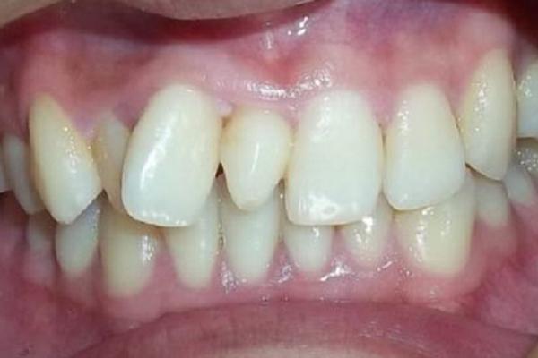 A Complete Guide To Hyperdontia (Extra Teeth) - Hawthorn Road Family Dental